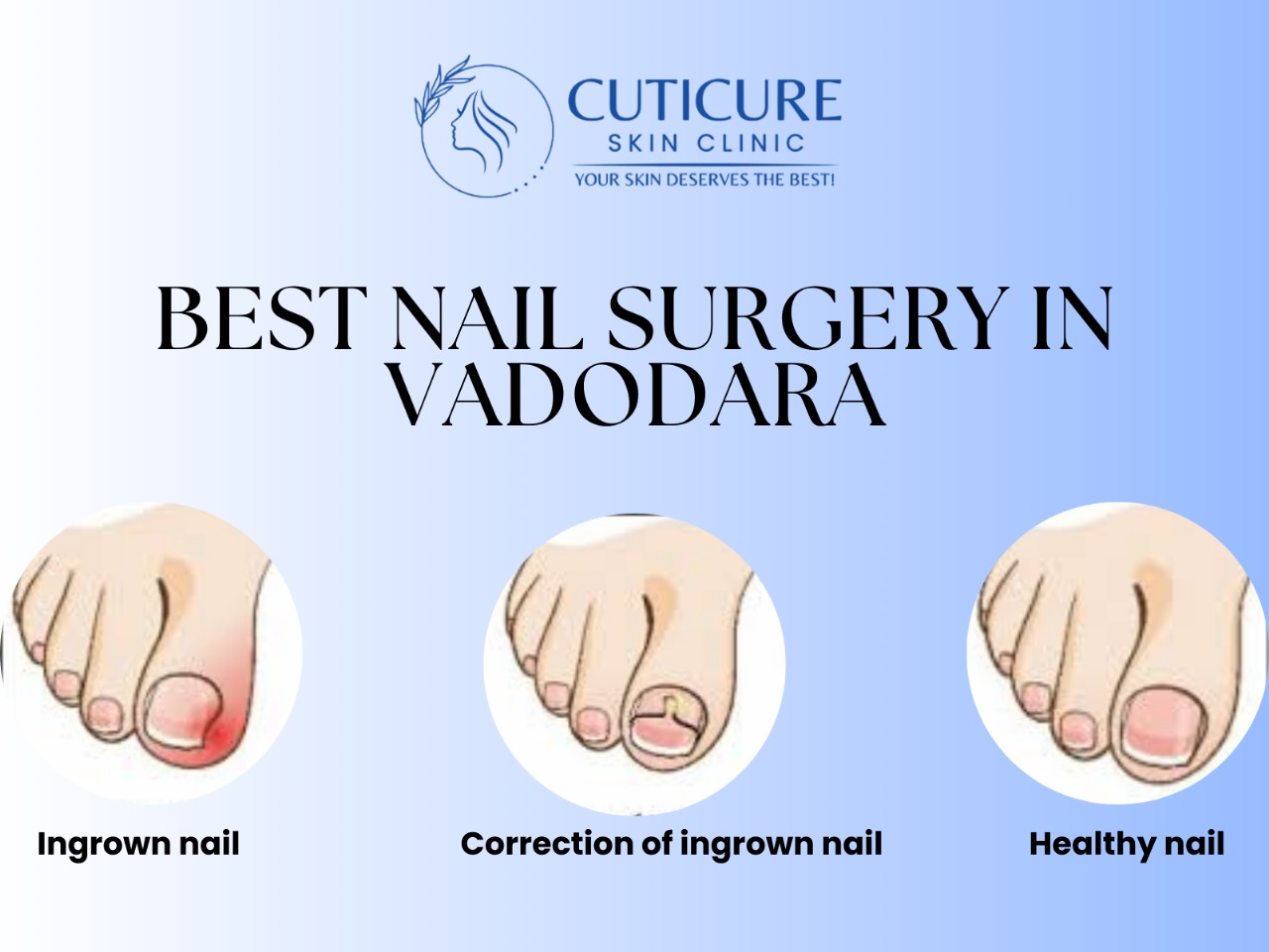 Best-Nail Surgery in Vadodara