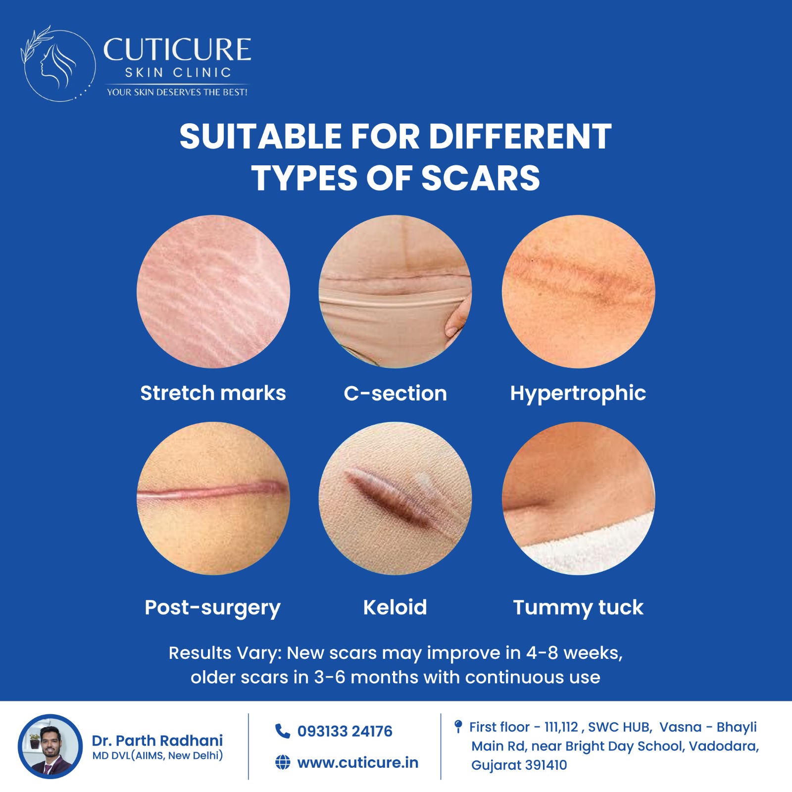 Keloids vs Hypertrophic Scars: Treatment Tips